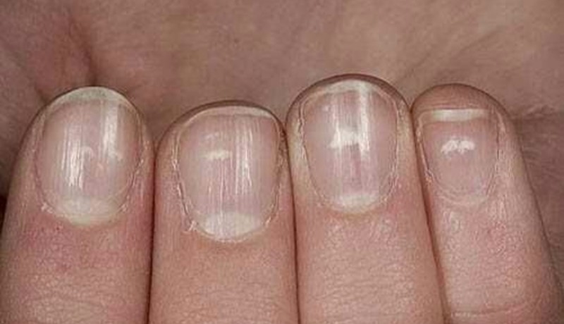 Waspada Bintik Putih di Kuku, Tanda Indikasi Penyakit Mengintai - GenPI.co